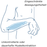 Spastik: Ursachen & Symptome | spastikinfo.de